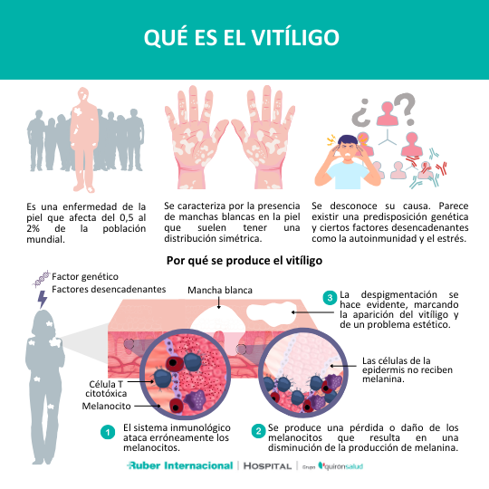 Vitíligo: causas, diagnóstico y tratamiento con Ruxolitinib (Opzelura)